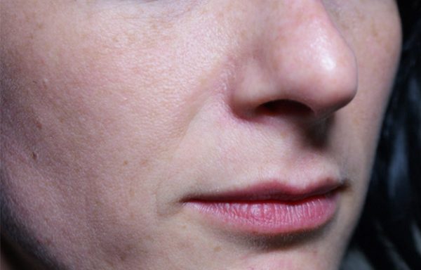 Treatment – Demodex and Rosacea Treatment